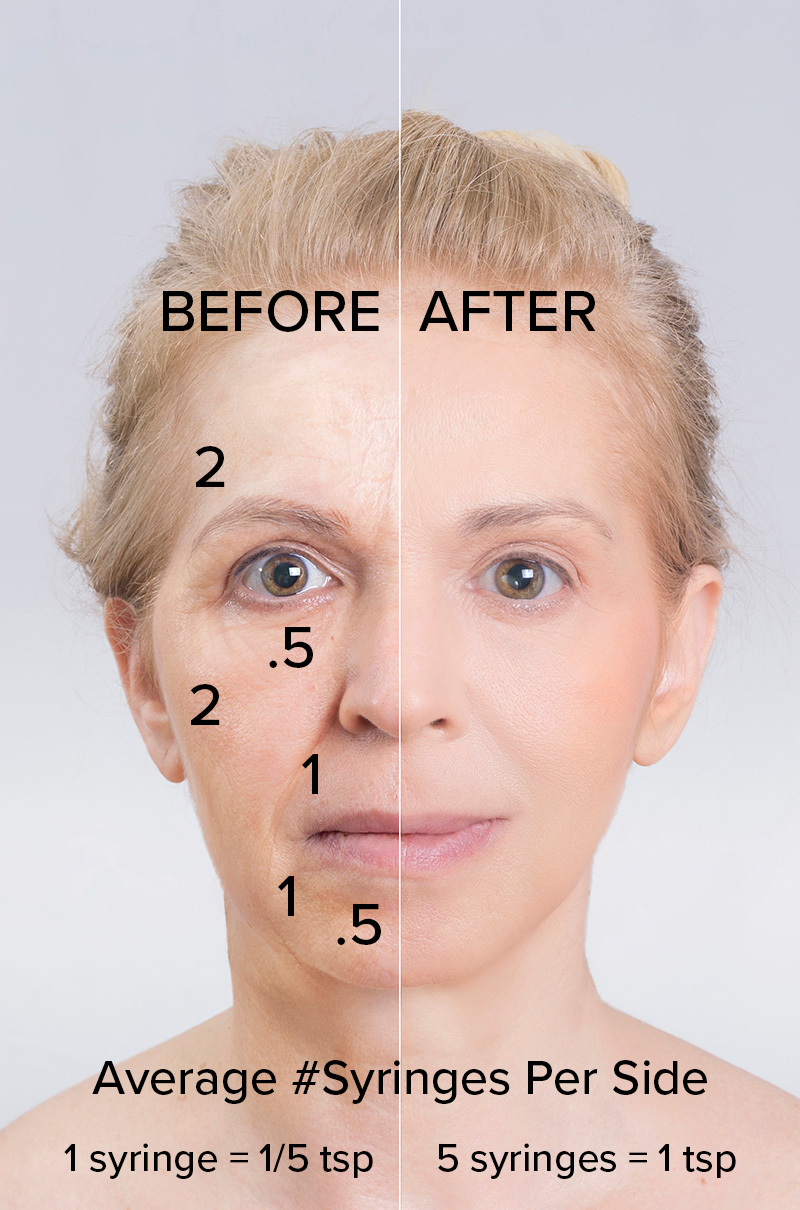 Bellafill West Palm Beach & Palm Beach Gardens | Dr. Mandal