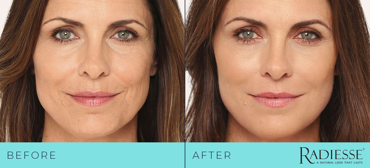 Radiesse® West Palm Beach & Palm Beach Gardens | Dr. Mandal